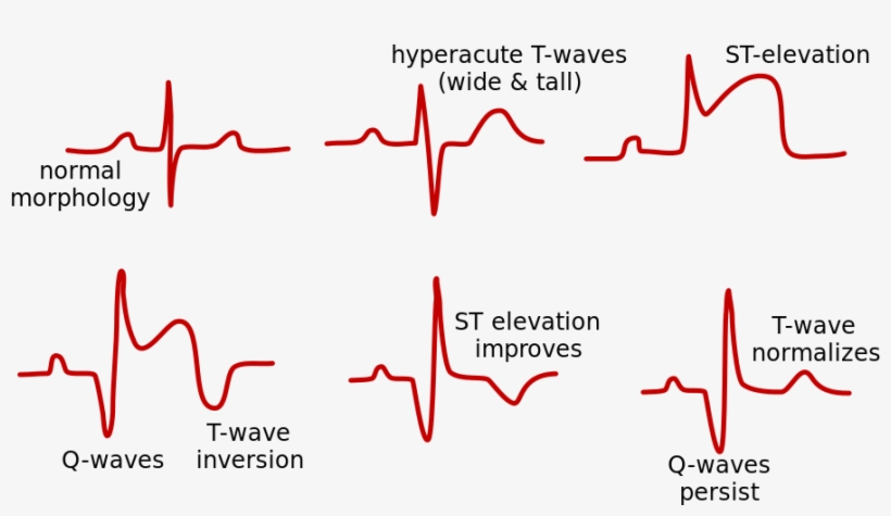 Monitor Like A Pro - Progression Of Stemi On Ecg PNG Image ...