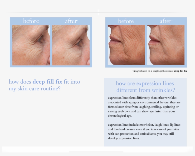 Apply Directly To Deep Wrinkle Areas Such As The Outer - Senior Citizen ...