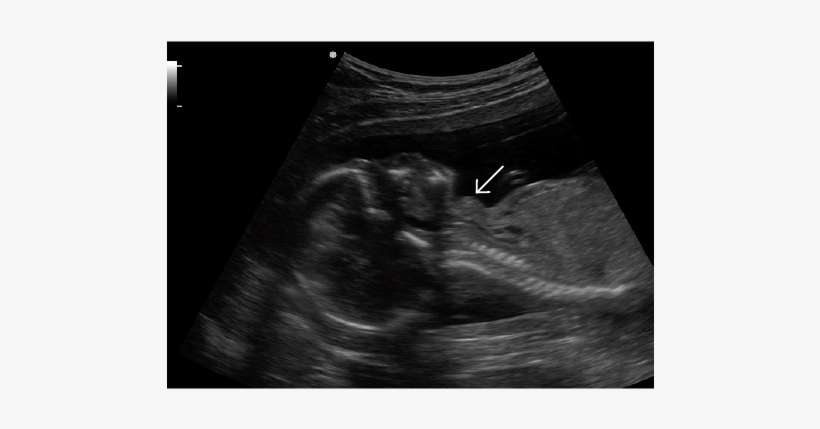 Fetal Goiter Ultrasound PNG Image | Transparent PNG Free Download on ...