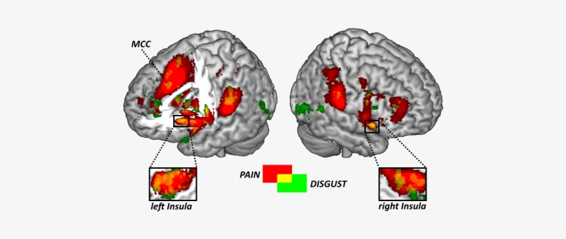 Meta-analysis - Pain Matrix Fmri PNG Image | Transparent PNG Free ...