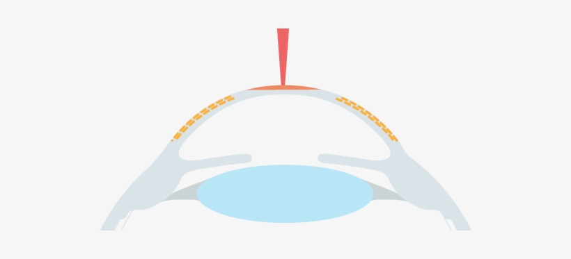 Epi Lasik/lasek/prk/no Touch Prk Schritt - Lasik PNG Image ...