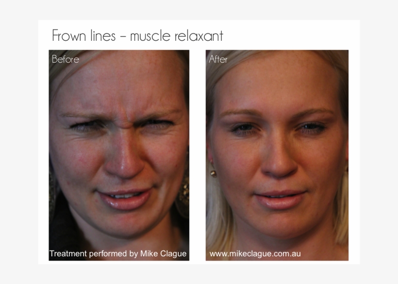 Download Frown Lines Muscle Relaxant - Collage | Transparent PNG ...