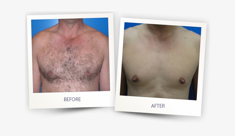 Hair Chest - Depilacion Del Pecho Antes Despues PNG Image | Transparent ...