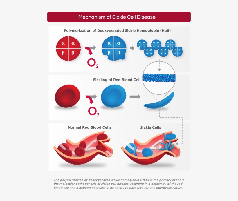Description Of Sickle Cell Pathophysiology Medical - Sickle Cell ...