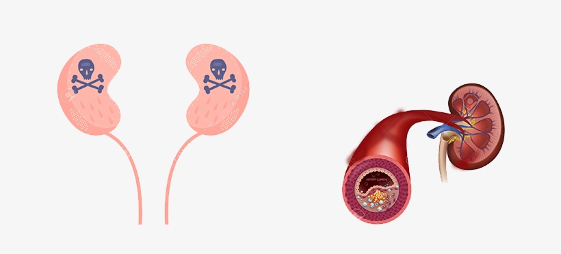 Download Kidney Failure - Kidney Failure Png | Transparent PNG Download ...