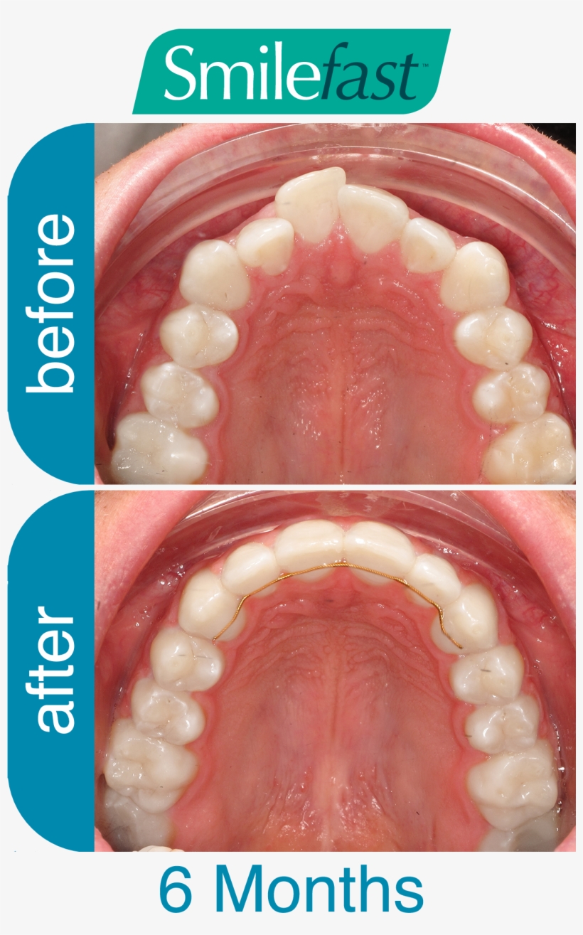 Buck Teeth Png PNG Images | PNG Cliparts Free Download on SeekPNG