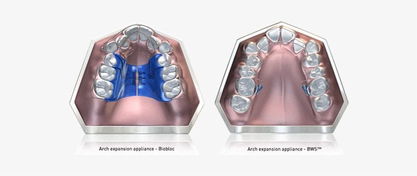 Bent Wire System - Bws Myobrace PNG Image | Transparent PNG Free ...