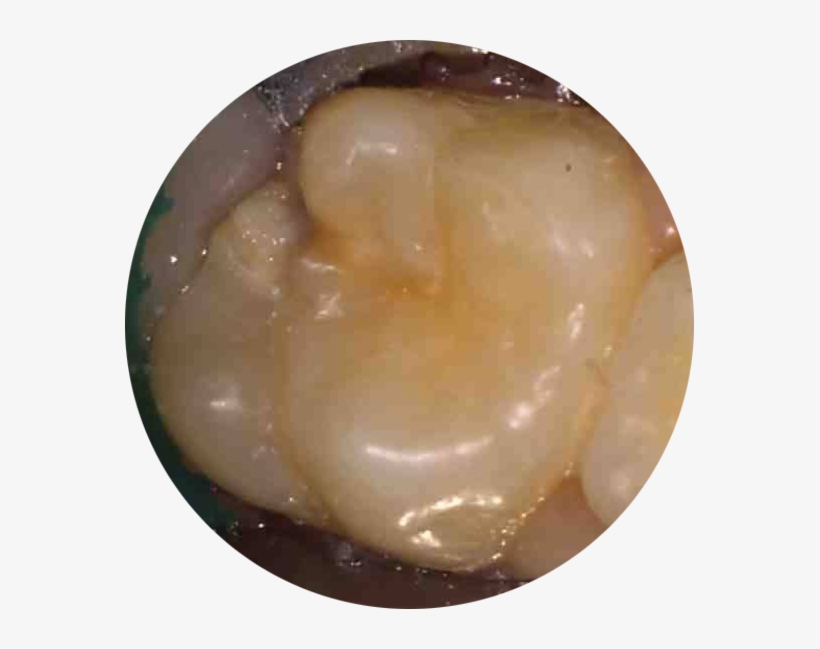 White Fillings - Before - Dental Restoration PNG Image | Transparent ...