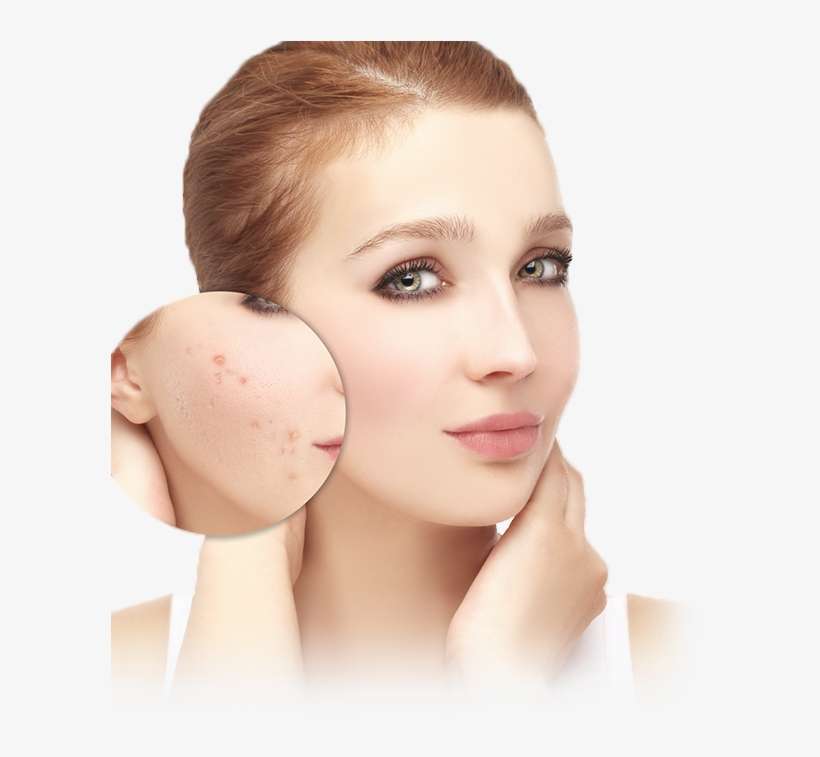 Home Page Slideshow Acne PNG Image | Transparent PNG Free Download on ...