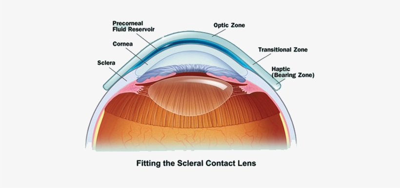 Scleral Contact Lenses - Intravitreal Injection PNG Image | Transparent ...