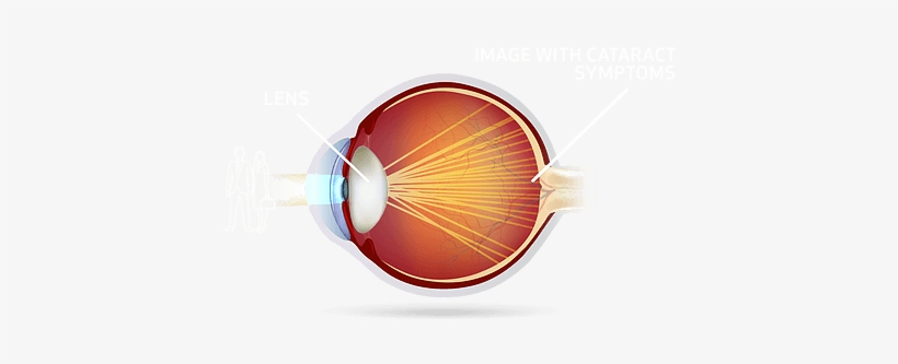 Cataract Clouded Lens - Circle PNG Image | Transparent PNG Free ...