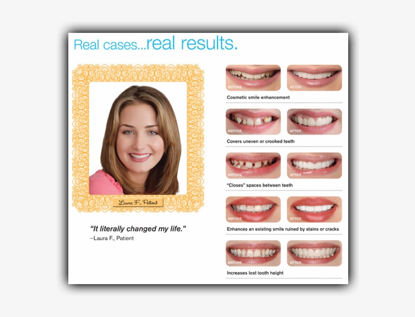 Snap On Smile - Snap On Smile Before And After PNG Image | Transparent ...