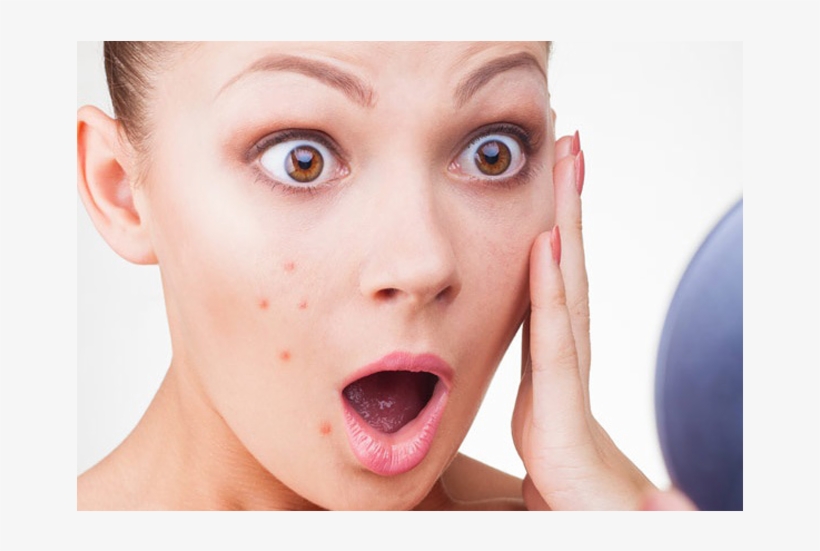 Face With Few Pimples PNG Image | Transparent PNG Free Download on SeekPNG