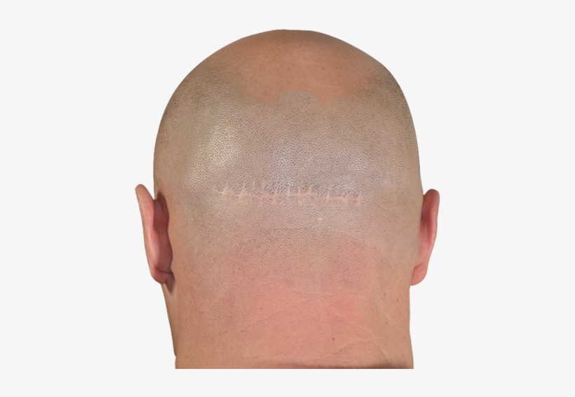 Scars Hairloss - Buzz Cut PNG Image | Transparent PNG Free Download on ...