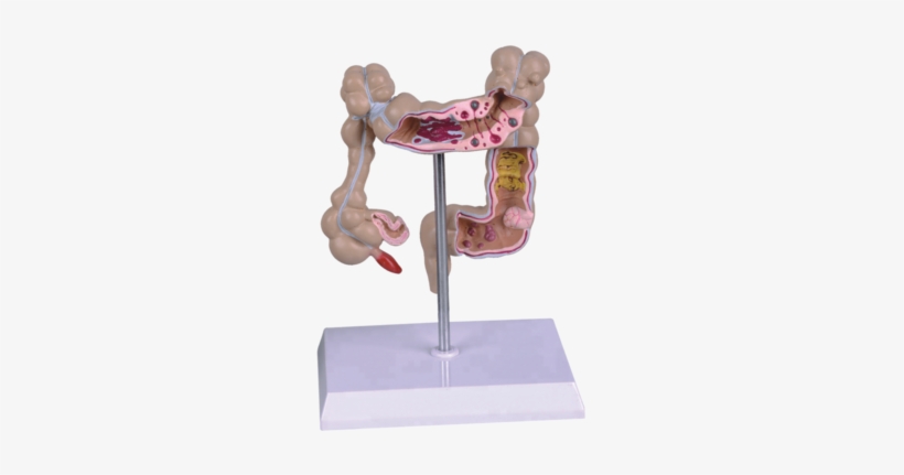 Human Diseased Large Intestines Model For Education - Carousel PNG ...
