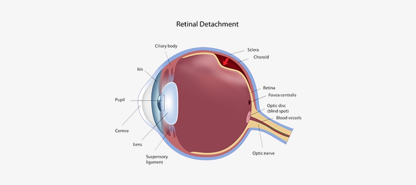 Download Retinal Detachment Austin, Texas - Retinal Detachment ...