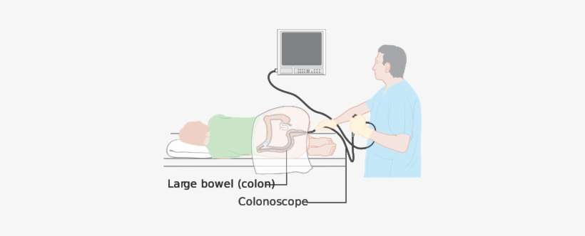 Colonoscopy Procedure - Colonoscopy PNG Image | Transparent PNG Free ...