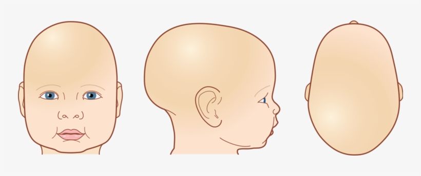 Download Scaphocephaly-example - Long Back Of Head | Transparent PNG ...