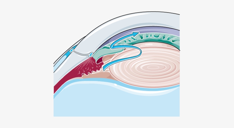 Angle-closure Glaucoma - Eye PNG Image | Transparent PNG Free Download ...