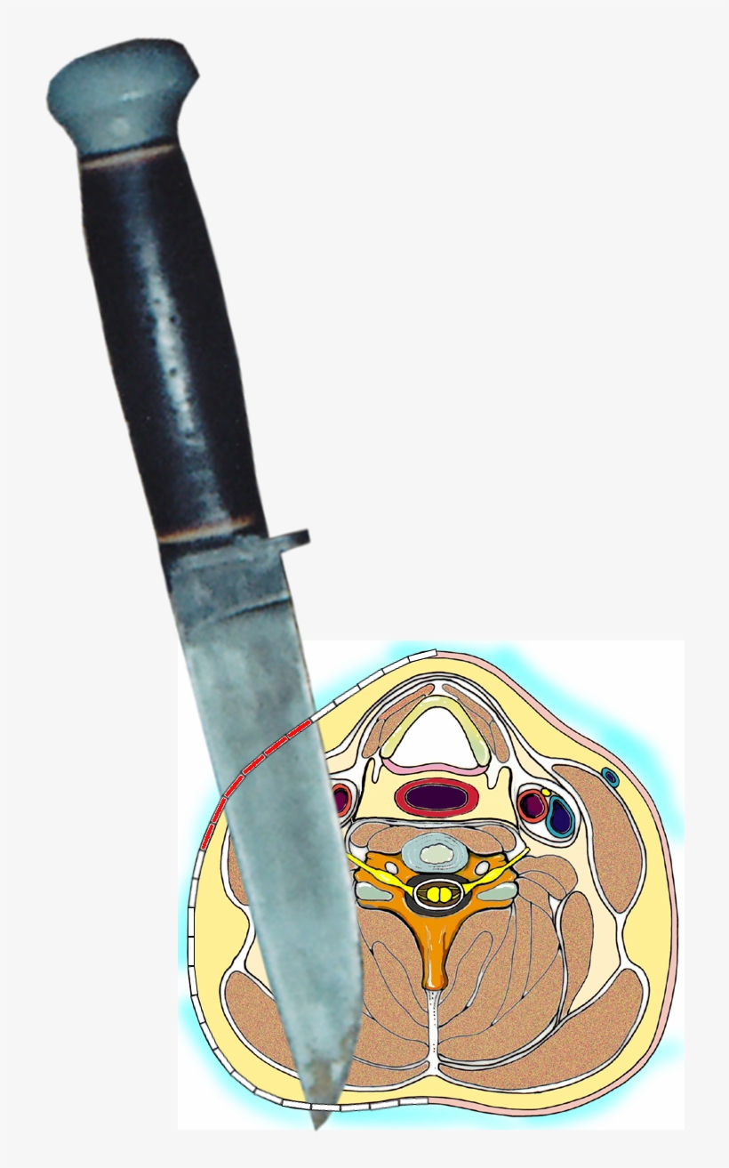 The Resulting Neck Wound Is Noticeably Smaller Than - Aiims Pg November ...