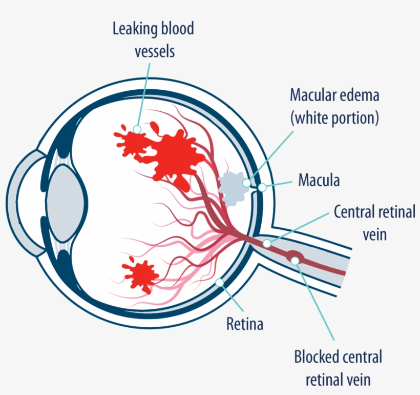 Download Eye With Macular Edema Following Retinal Vein Occlusion ...