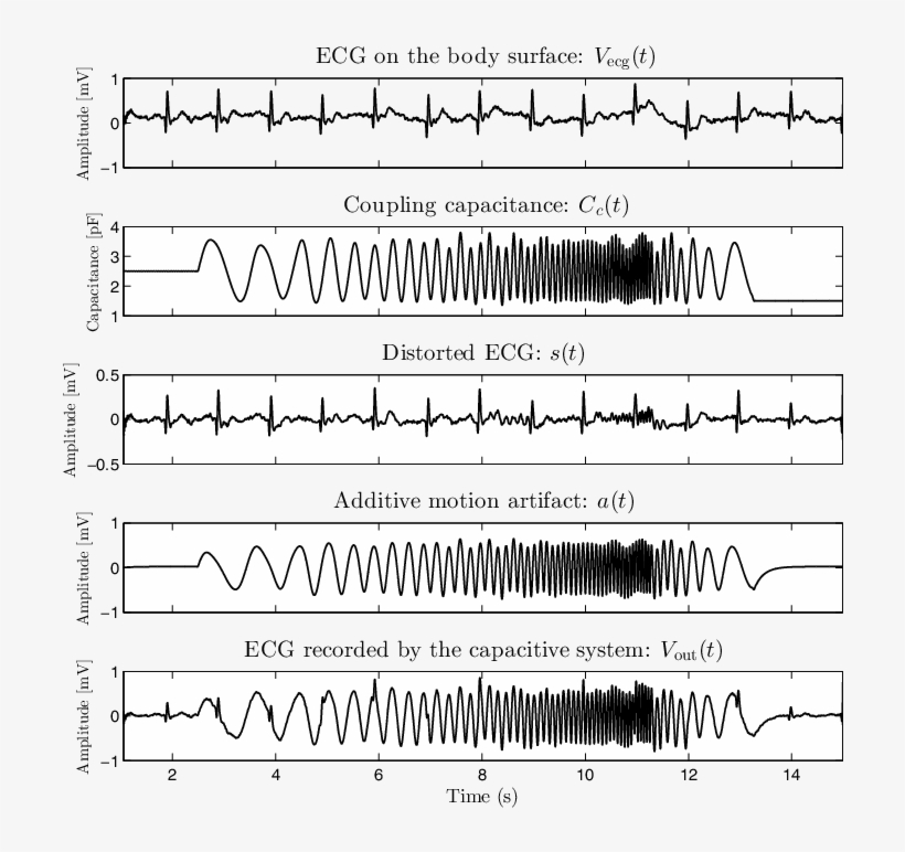 Illustration Of An Ecg Distortion And A Motion Artifact - Artifact PNG ...