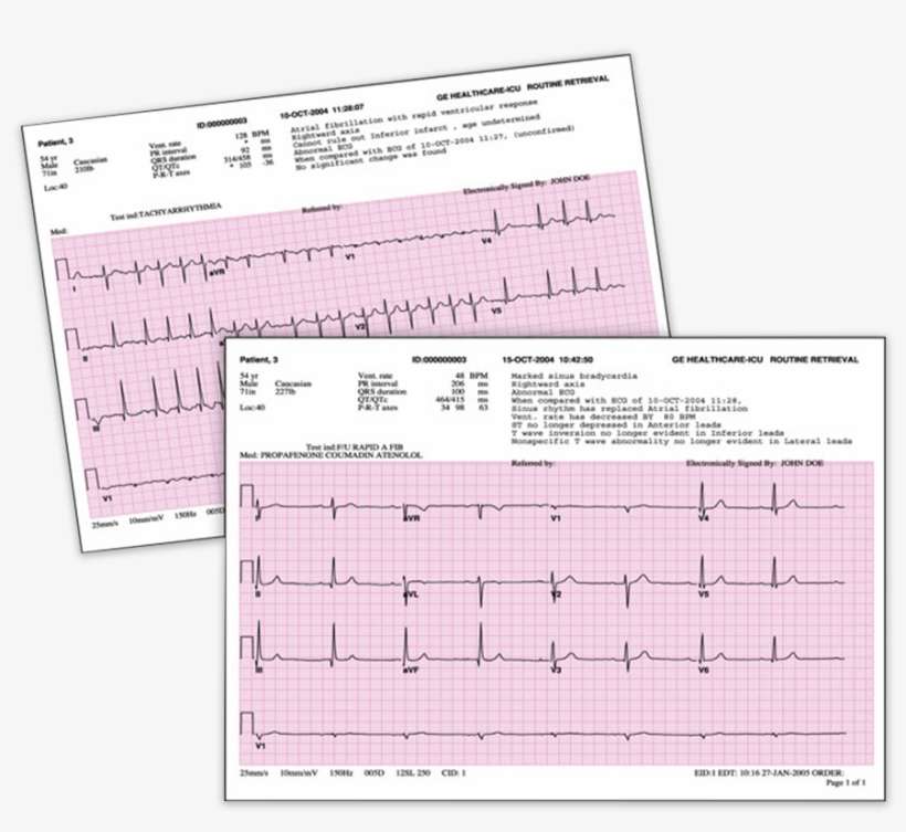 Ecg Analysis Sheets - Analysis PNG Image | Transparent PNG Free ...