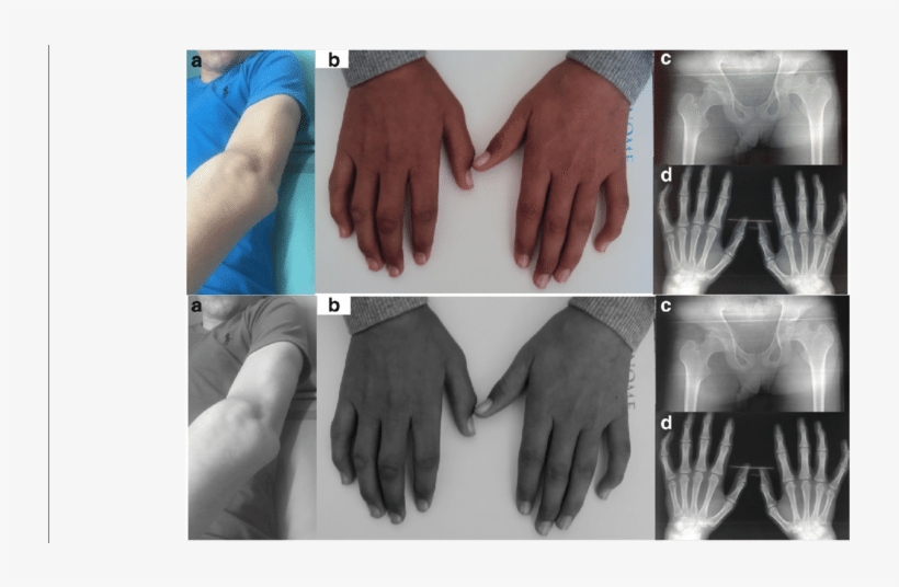 Clinical Features Of Scleroderma-like - Bone PNG Image | Transparent ...