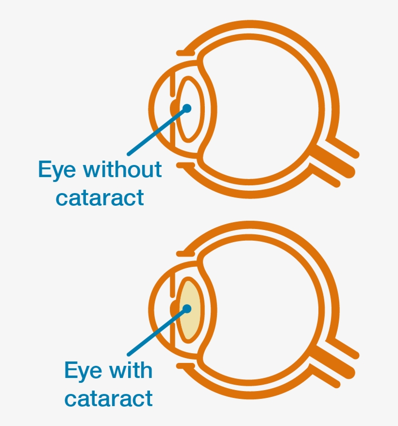 They Develop Gradually, Like Dirt Slowly Building Up - Illustration PNG ...