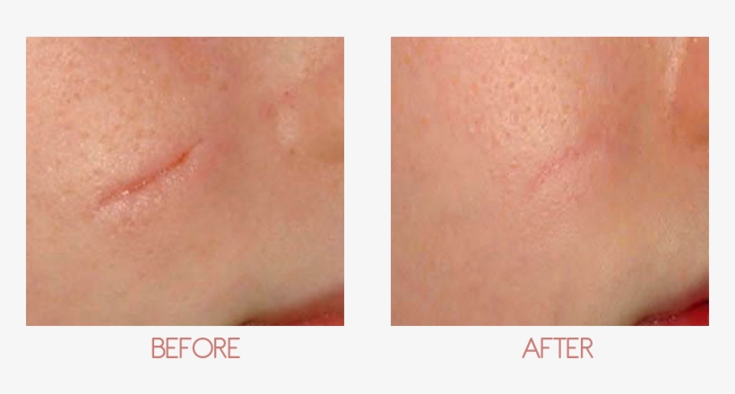 Scar PNG Image | Transparent PNG Free Download on SeekPNG