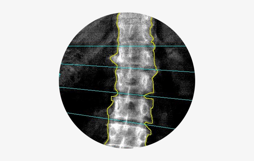 Abnormal Dexa Scan PNG Image | Transparent PNG Free Download on SeekPNG