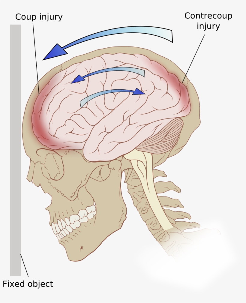 Types Of Brain Damage Abi PNG Image | Transparent PNG Free Download on ...