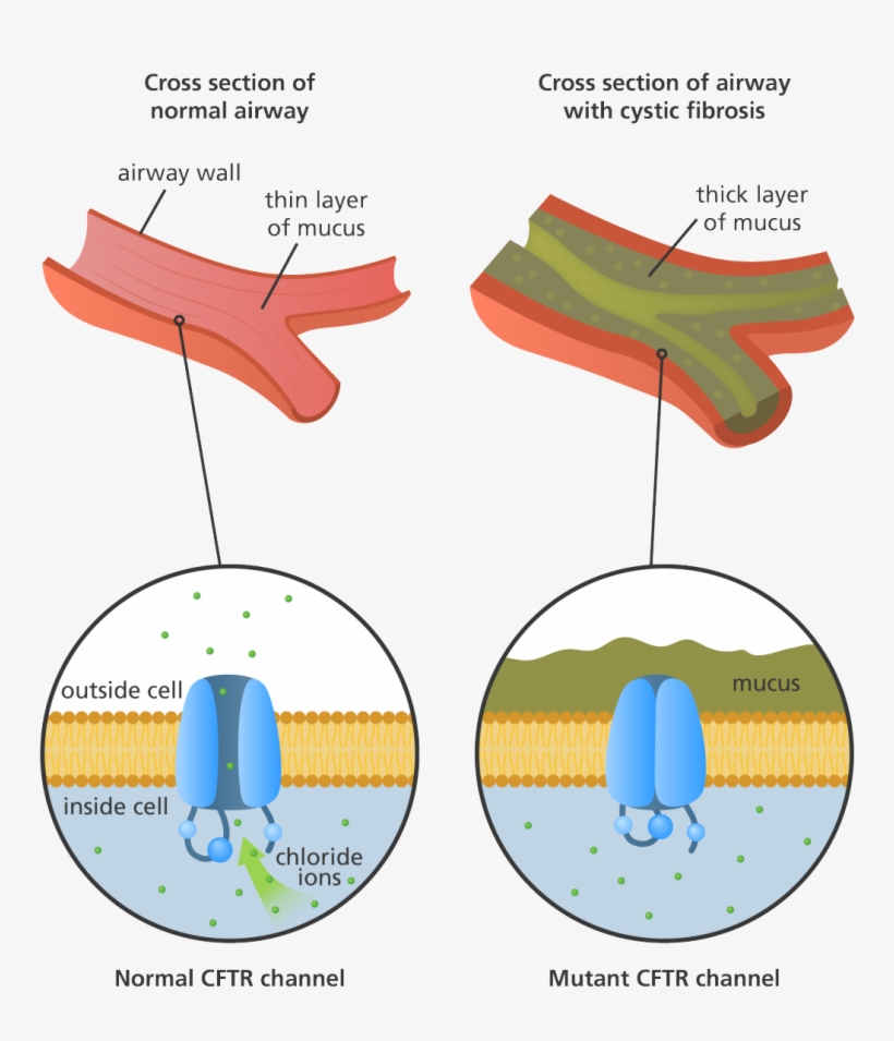 An Illustration To Show Normal And Mutant Cftr Channels, - Cftr Cystic ...