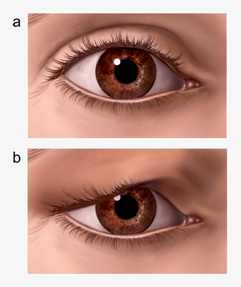 Illustration Showing A Normal Eyelid And Sagging Eyelid - Eye ...