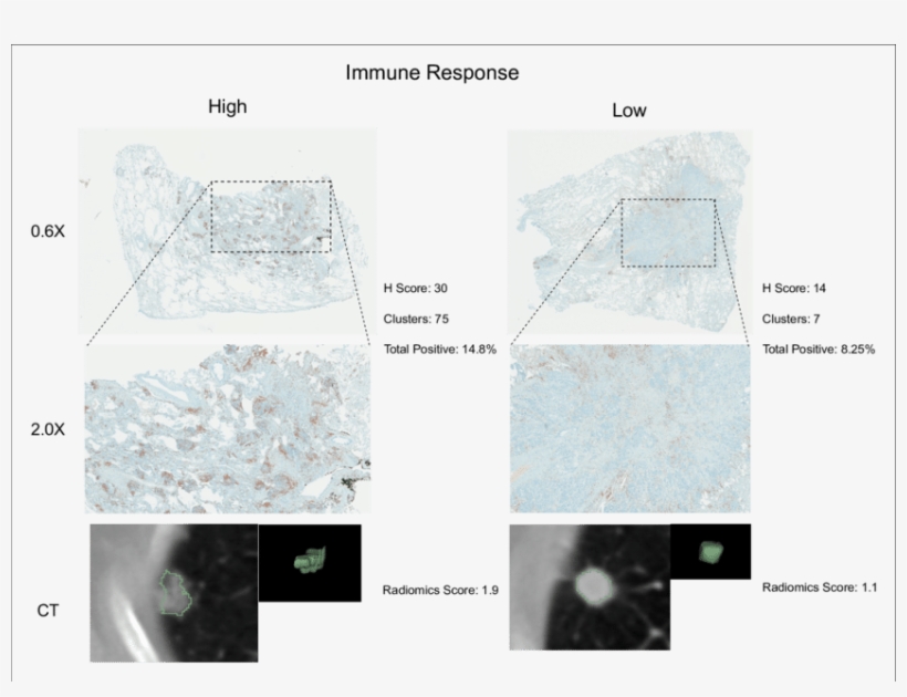 Test For Agreement Between Radiomic And Pathological PNG Image ...