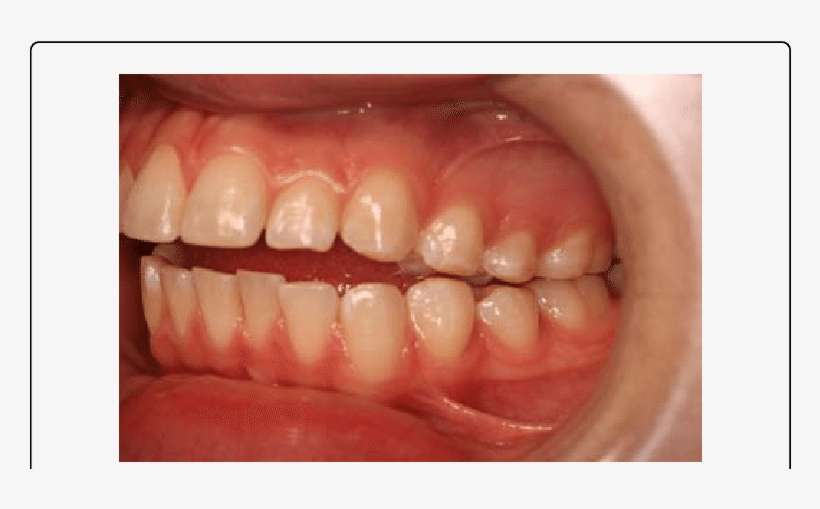Note The Flattened Cusps Of Posterior Teeth, Indicating PNG Image ...