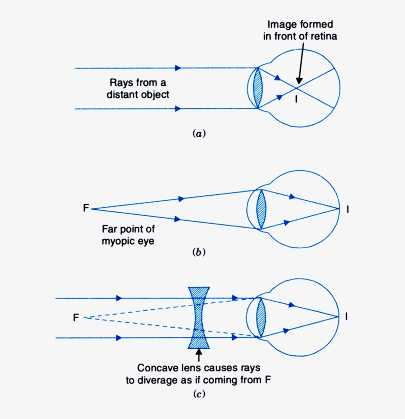 Human Eye And Colourful World - Correction Of Myopic Eye PNG Image ...