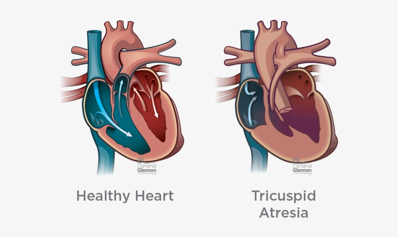 Hypoplastic Right Heart Syndrome - Truncus Arteriosus PNG Image ...