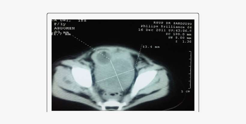 Ct-scan Found Heterogeneous Mass With Solid And Cystic - Urinary ...