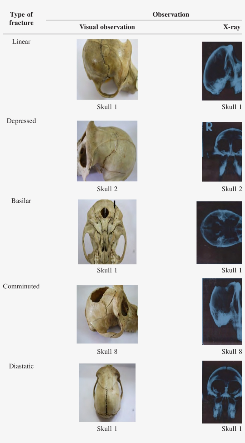 Types Of Skull Fractures Encountered - Skull Fracture Types Forensic ...