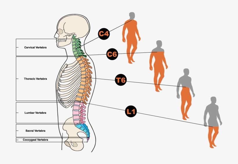 Diagram Showing Different Types Of Spinal Cord Injuries - Illustration ...