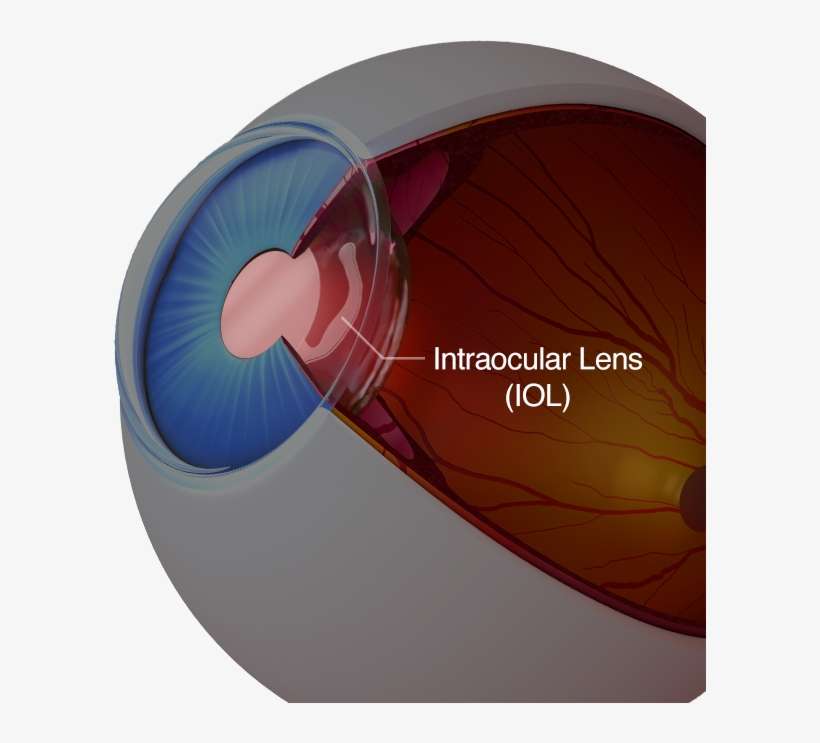 A Multifocal Intraocular Lense Displayed Against A - Iol Refractive ...