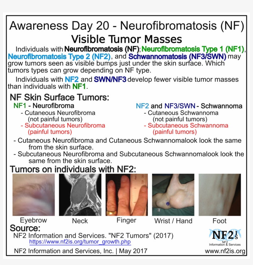 Nf Awareness Eyes Swn Skin Surface Tumors - Neurofibromatosis Types PNG ...