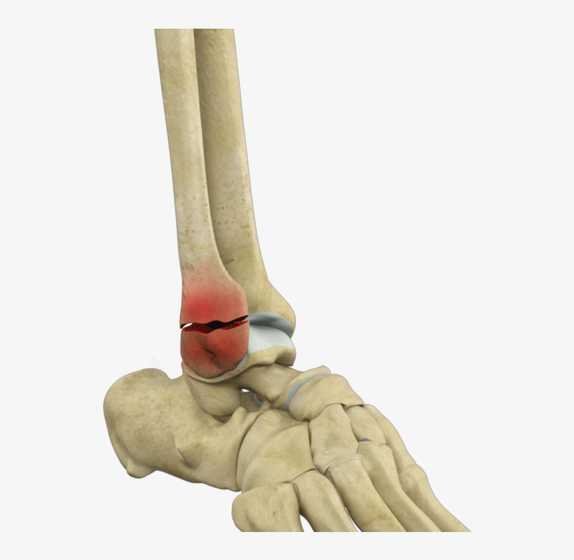 Transparent Broken Ankles PNG Image | Transparent PNG Free Download on ...