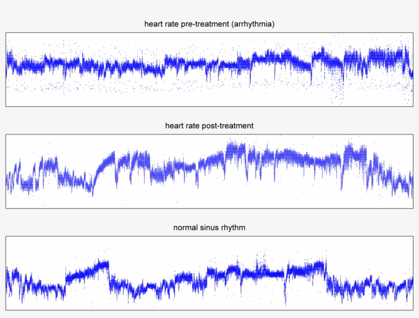 Img/fig Hrv Drug Pre Post Nsr - Calligraphy PNG Image | Transparent PNG ...