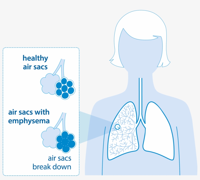 Diagram Of Lungs With Emphysema - Lung Volume Reduction Surgery Coils ...