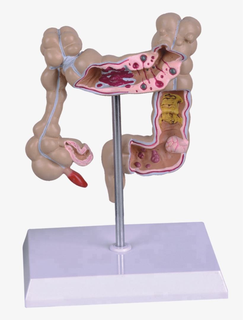 Human Diseased Large Intestines Model For Education - Child Carousel ...