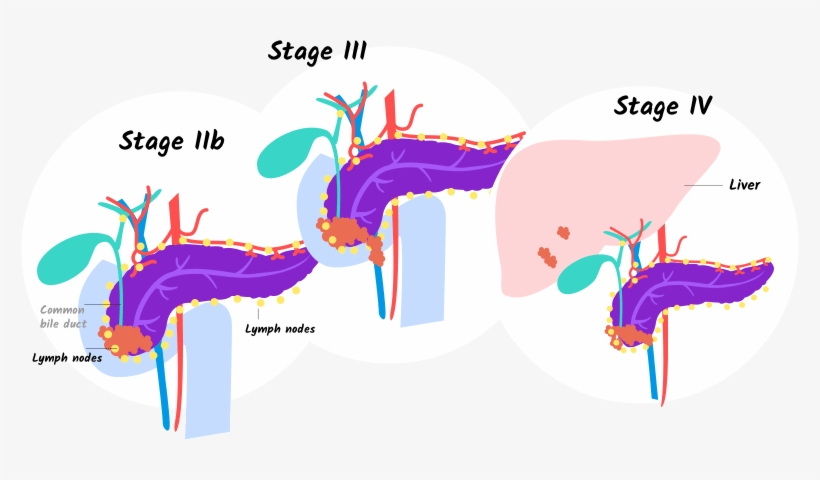Illustration Of Stages Iib, Iii, And Iv Of Pancreatic - Does Stage 4 ...