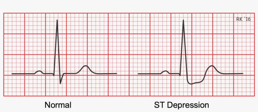 Cad012 Ecg St Depression - St Segment Depression PNG Image ...