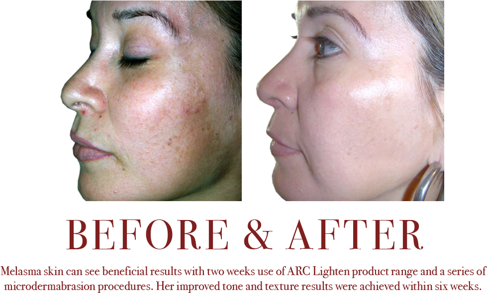 Lightening Melasma Mottled Skin Tone Discolorations - Poster (1164x600 ...